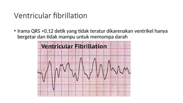 penanganan kasus TAKIKARDIA berdasarkan .ppt