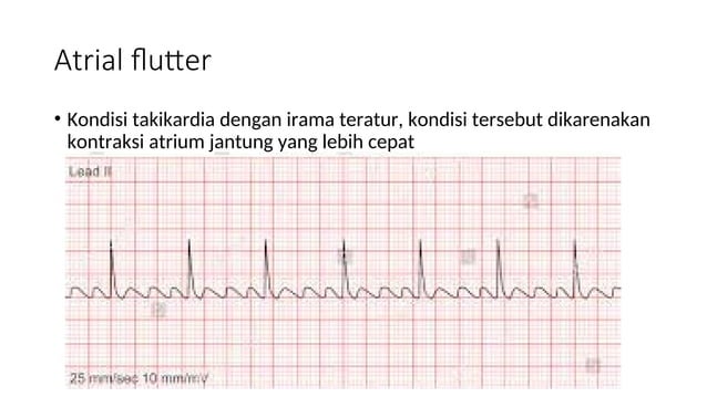 penanganan kasus TAKIKARDIA berdasarkan .ppt