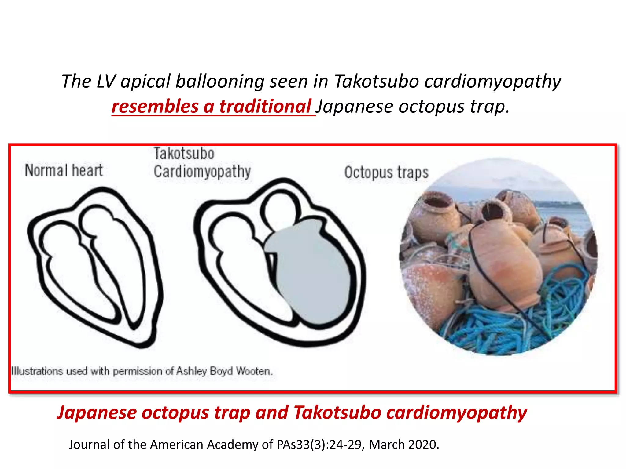 Broken Heart Syndrome.Takotsubo Syndrome | PPTX