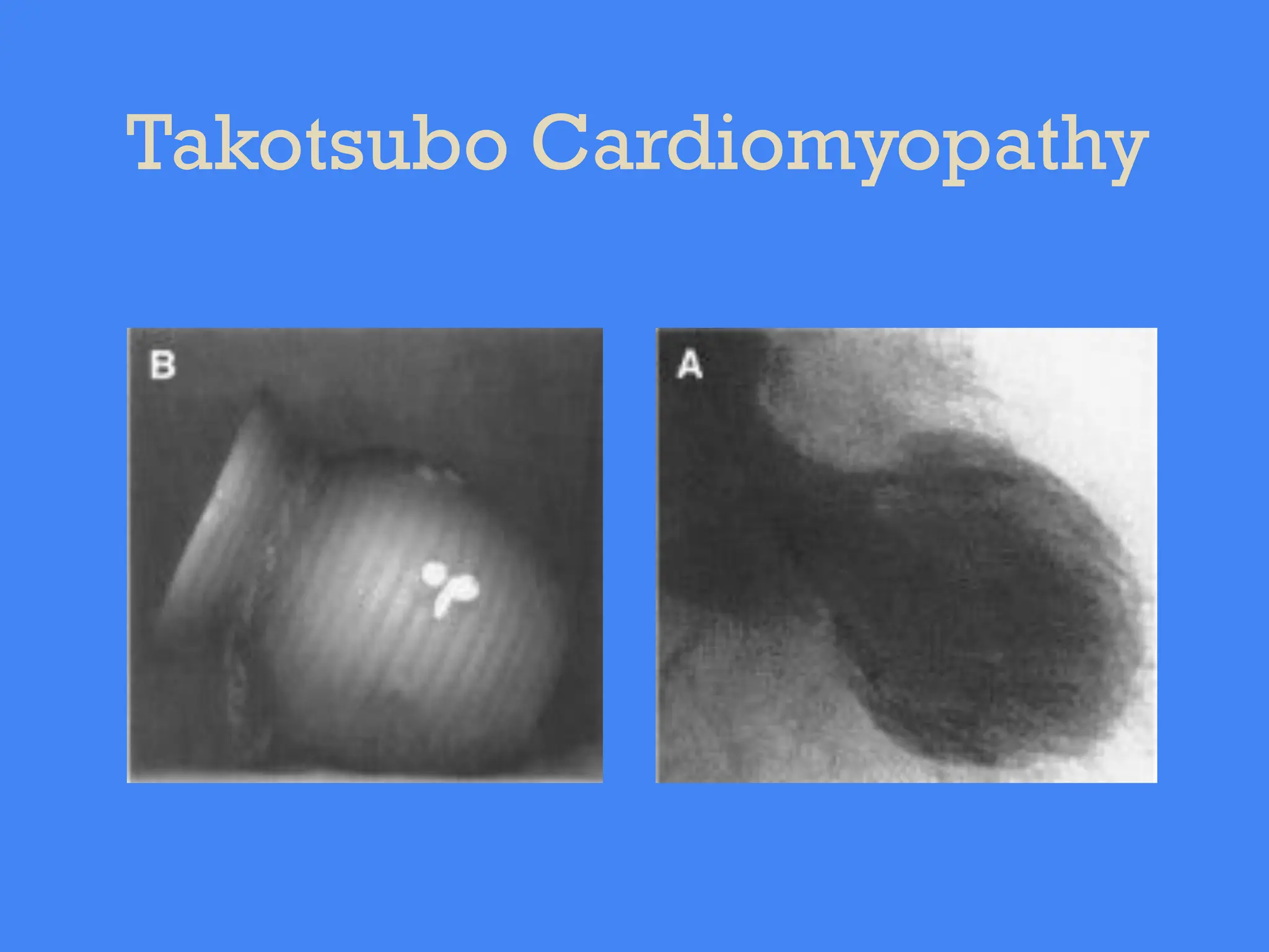 takotsubo cardiomyopathy/ Broken Heart Syndrome | PDF