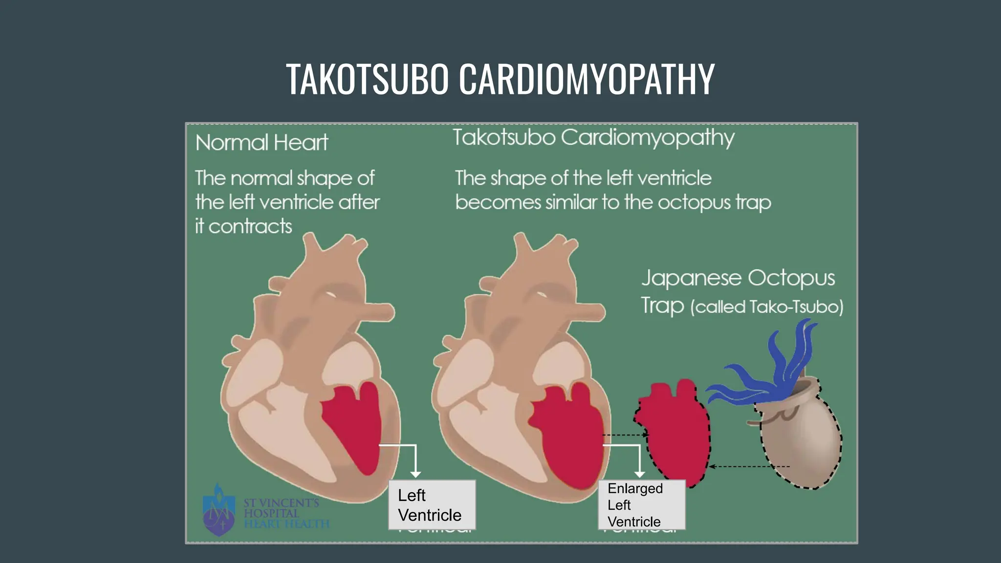 Takotsubo cardiomyopathy ( The broken heart syndrome ).pdf