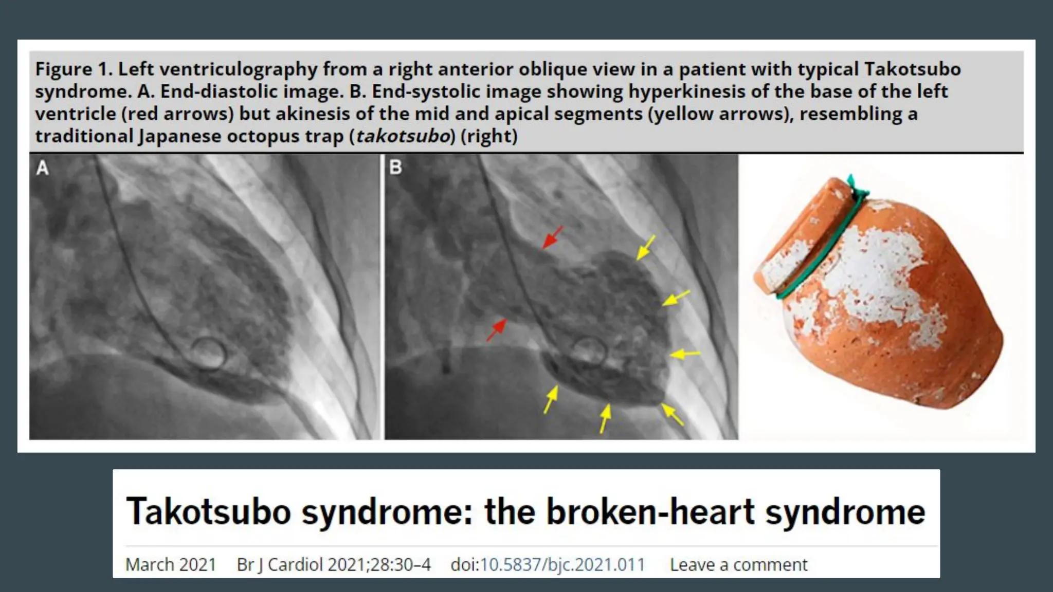 Takotsubo cardiomyopathy ( The broken heart syndrome ).pdf