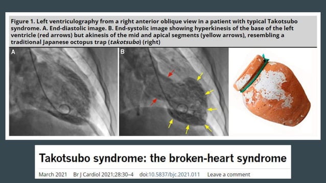 Takotsubo cardiomyopathy ( The broken heart syndrome ).pdf