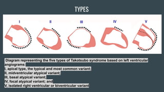 Takotsubo cardiomyopathy ( The broken heart syndrome ).pdf
