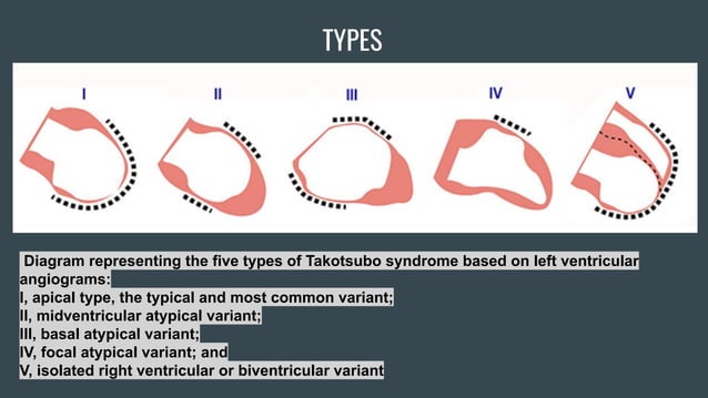 Takotsubo cardiomyopathy ( The broken heart syndrome ).pdf