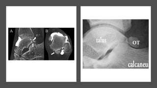 AJM Sheet: Talar fracture | PPTX | Death, Injury, or Military Conflict ...