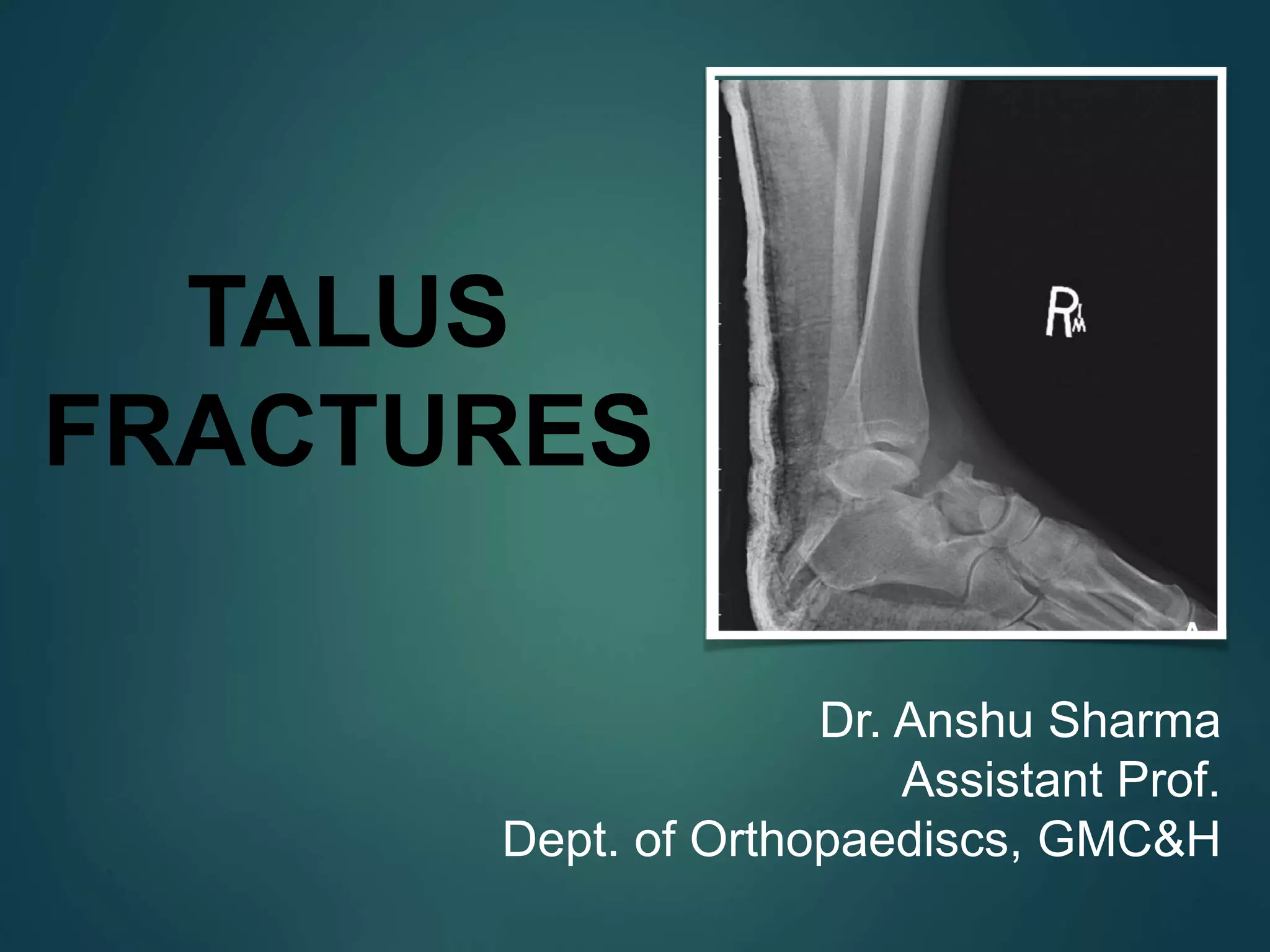 TALUS FRACTURE AND MANAGEMENT. | PPTX