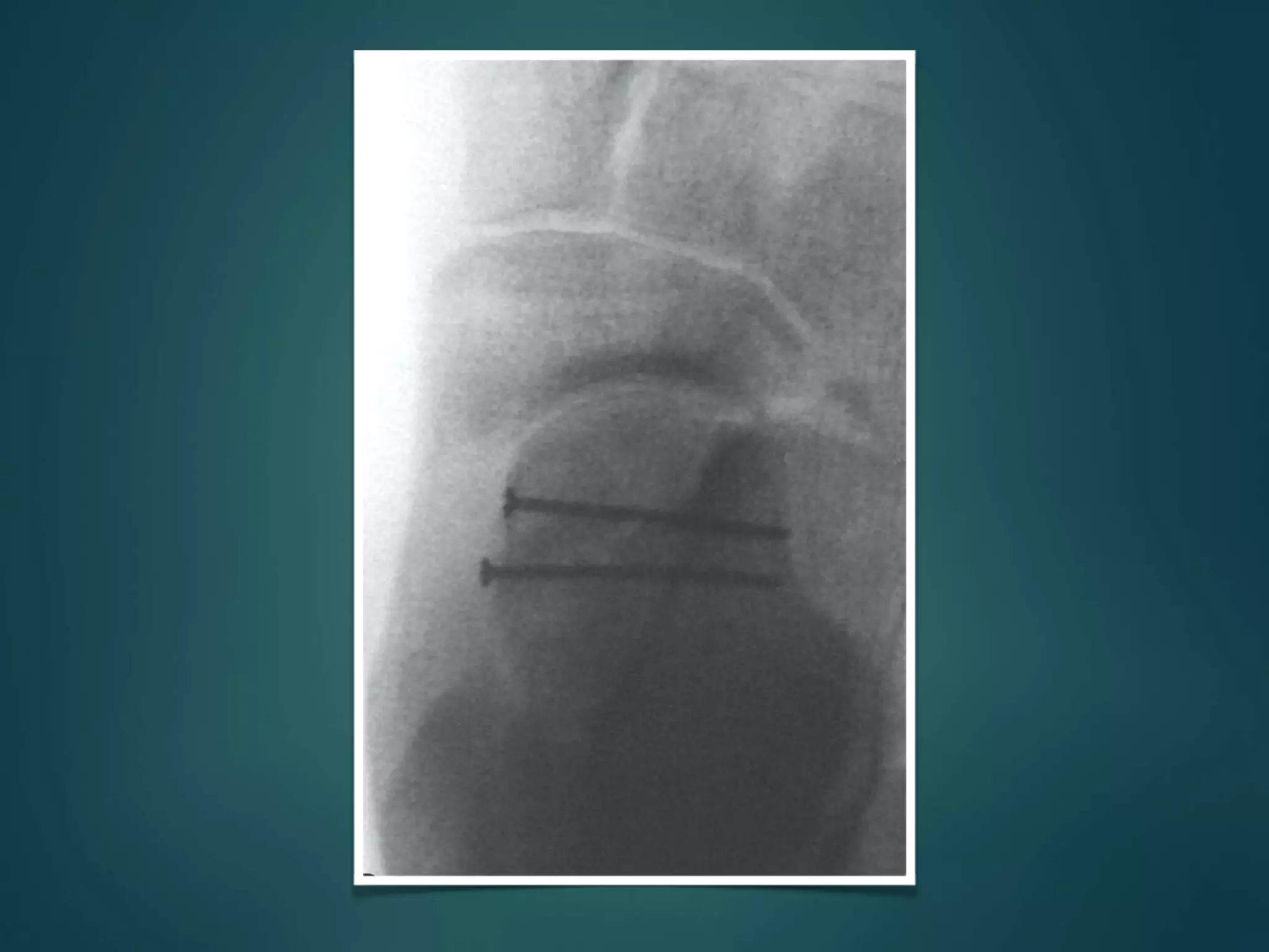 TALUS FRACTURE AND MANAGEMENT. | PPTX