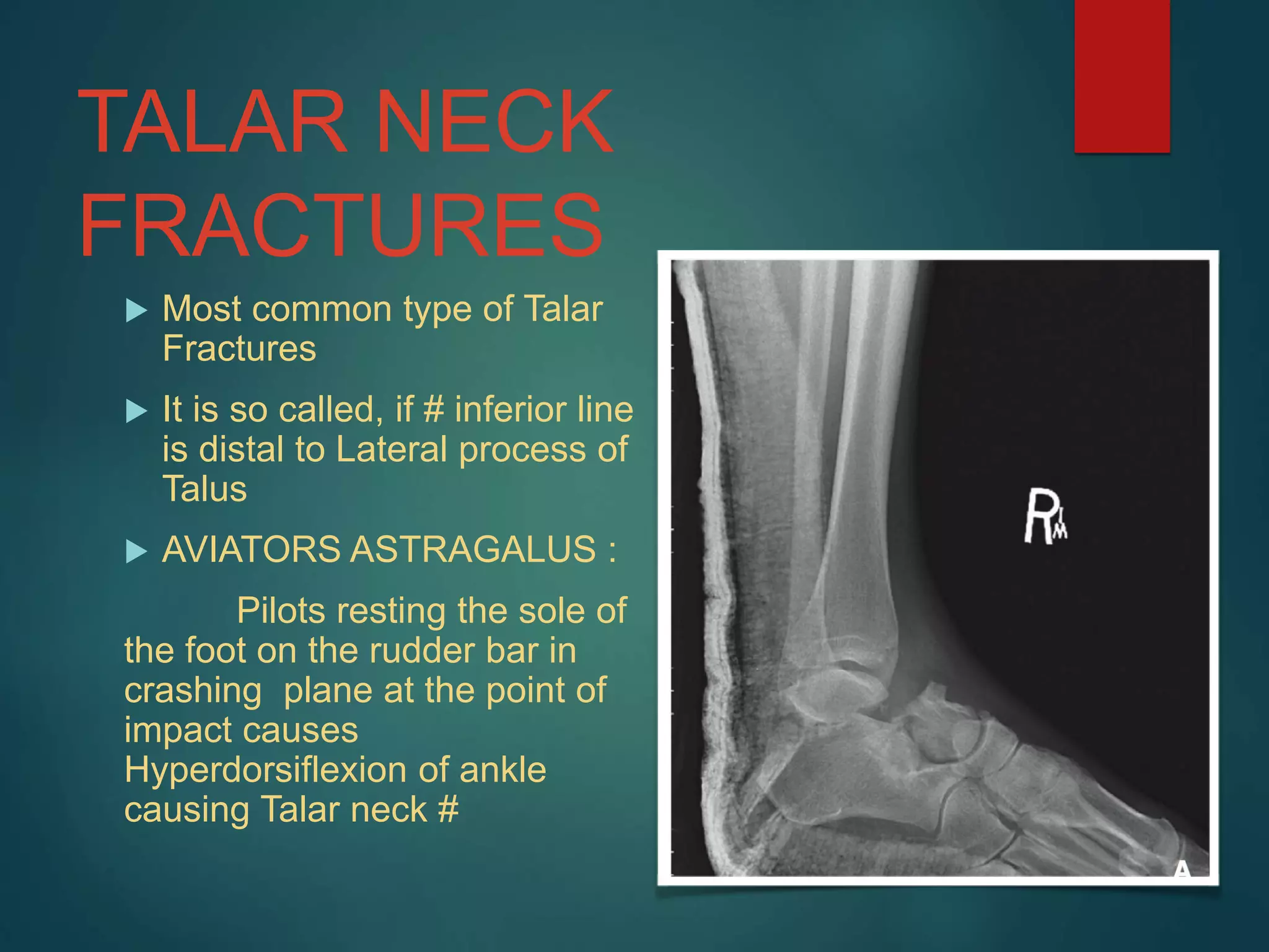 TALUS FRACTURE AND MANAGEMENT. | PPTX