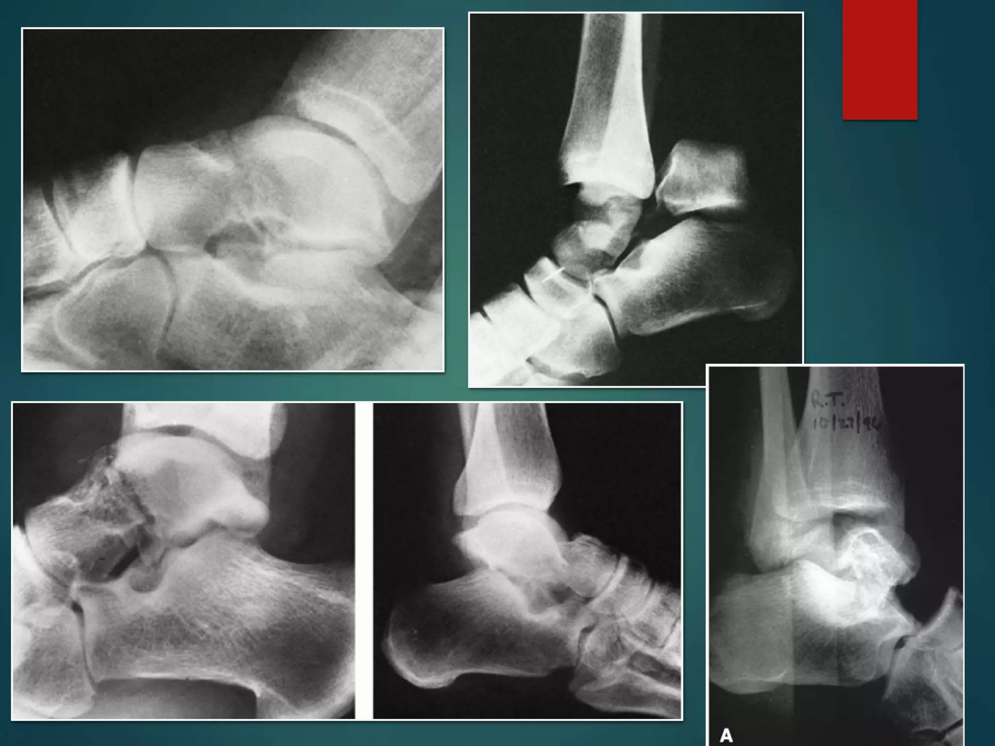 TALUS FRACTURE AND MANAGEMENT. | PPTX