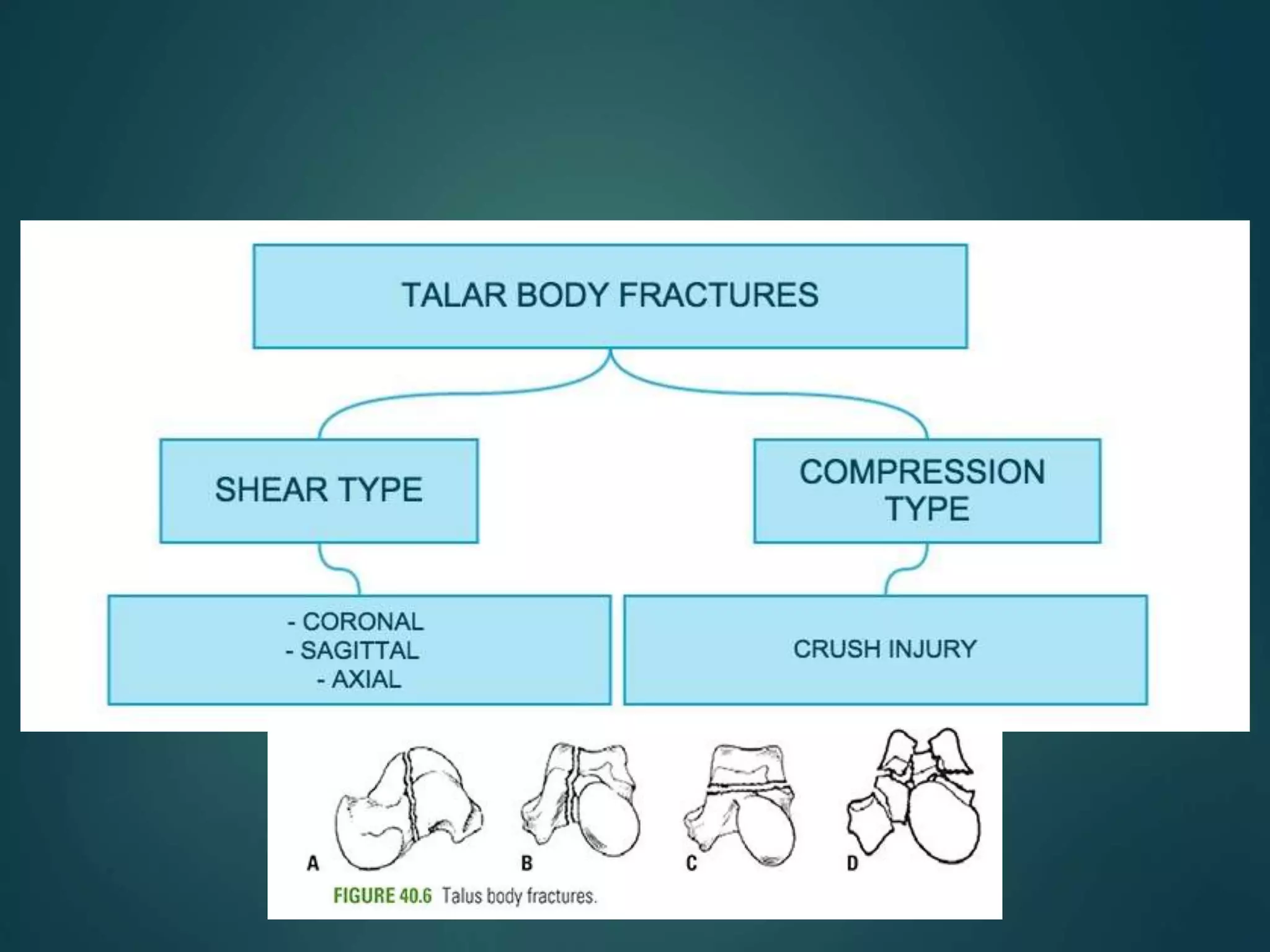 TALUS FRACTURE AND MANAGEMENT. | PPTX