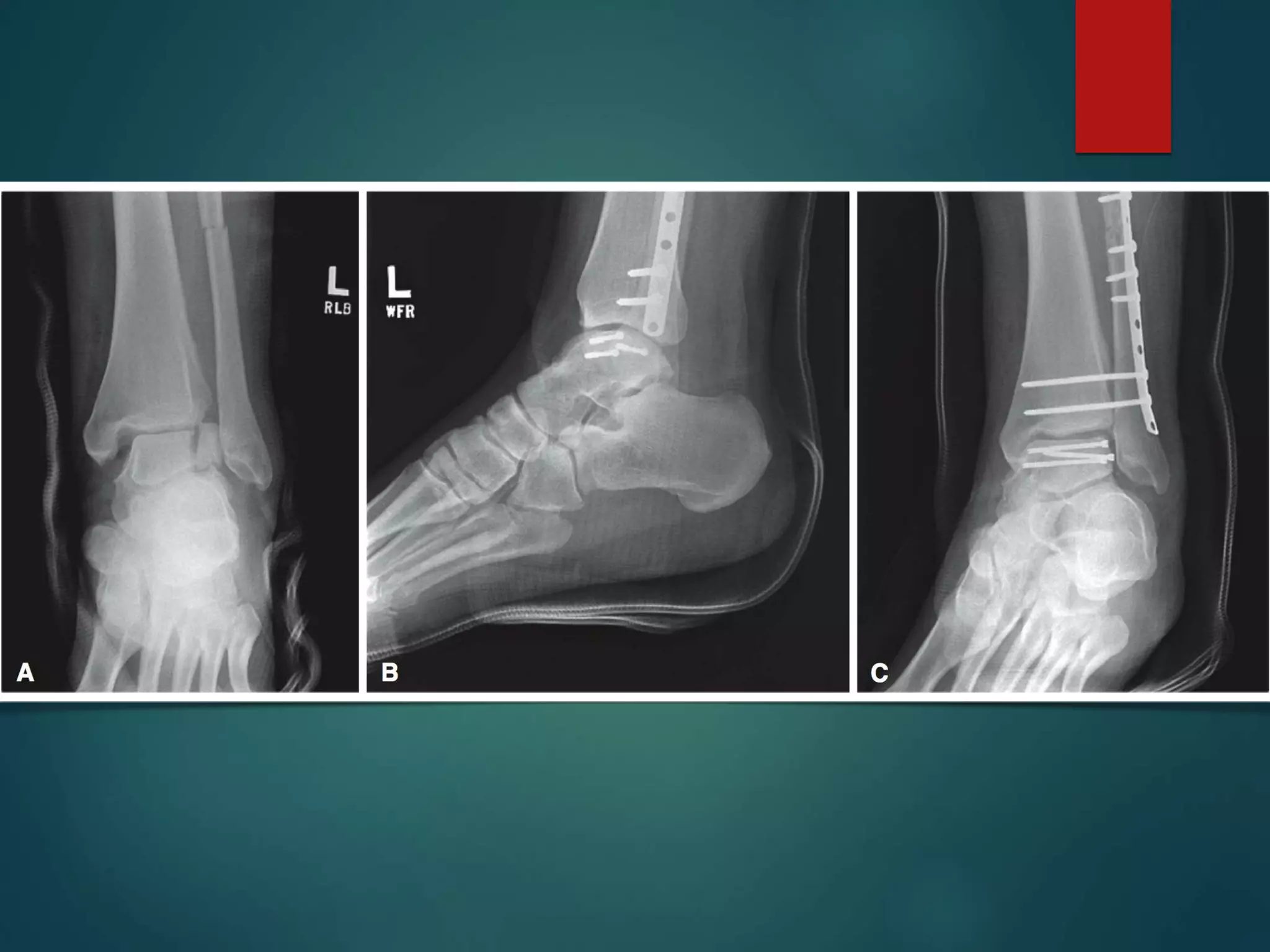 TALUS FRACTURE AND MANAGEMENT. | PPTX