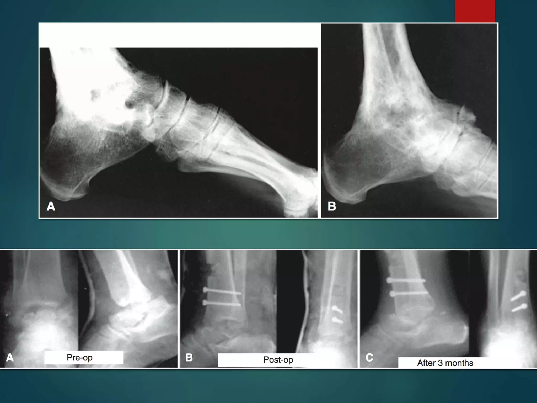 TALUS FRACTURE AND MANAGEMENT. | PPTX | Death, Injury, or Military ...