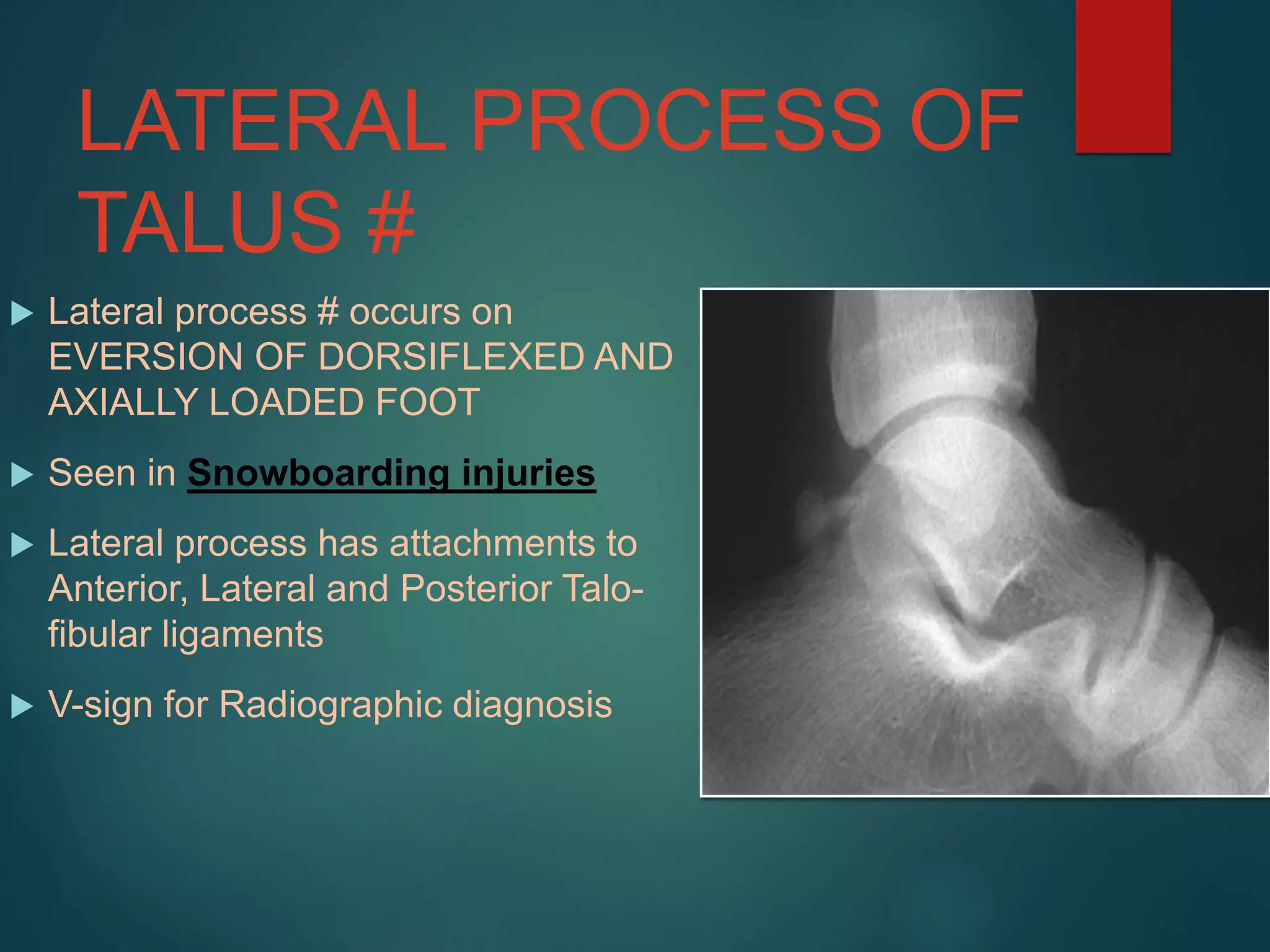 TALUS FRACTURE AND MANAGEMENT. | PPTX