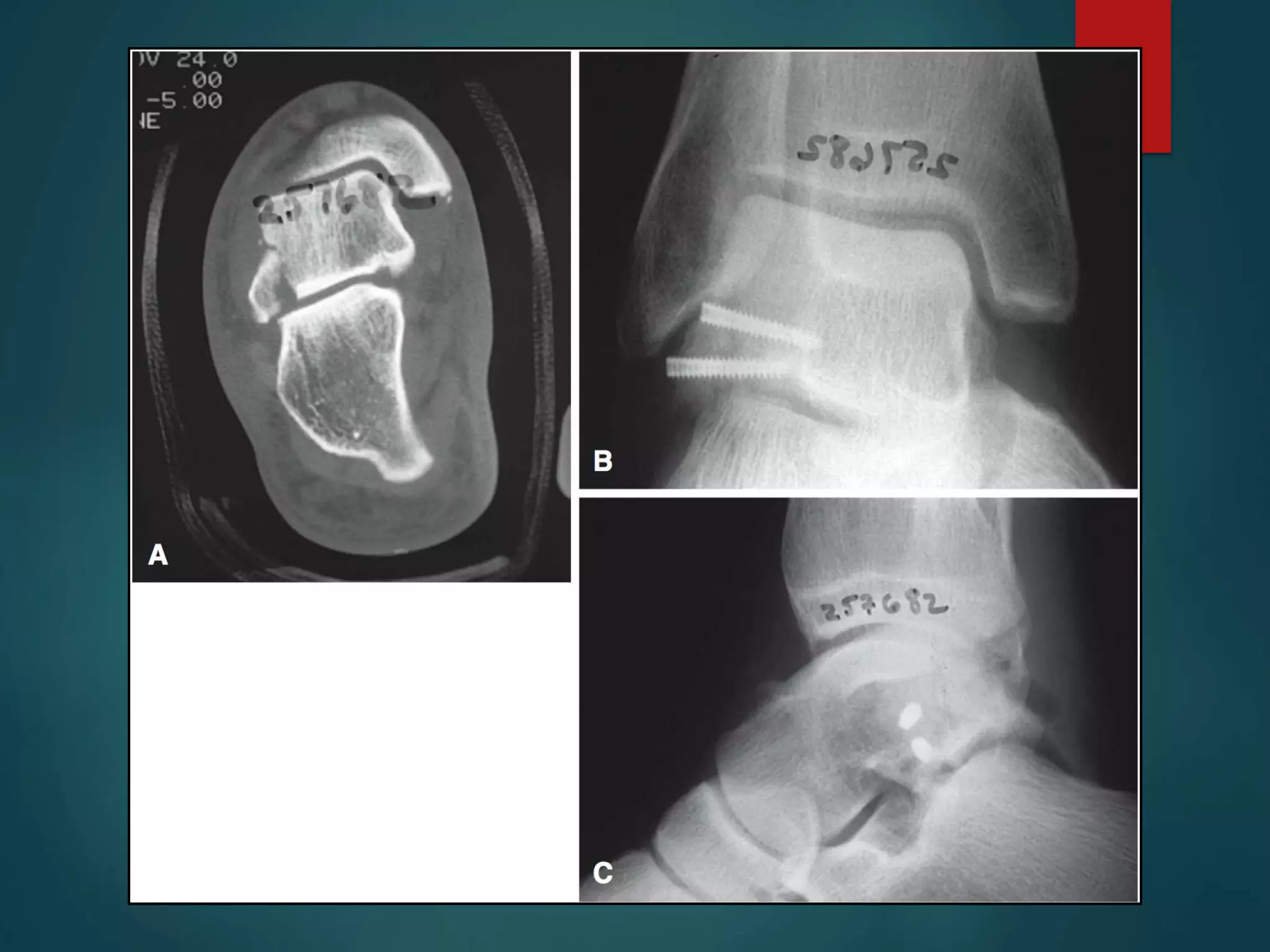 TALUS FRACTURE AND MANAGEMENT. | PPTX