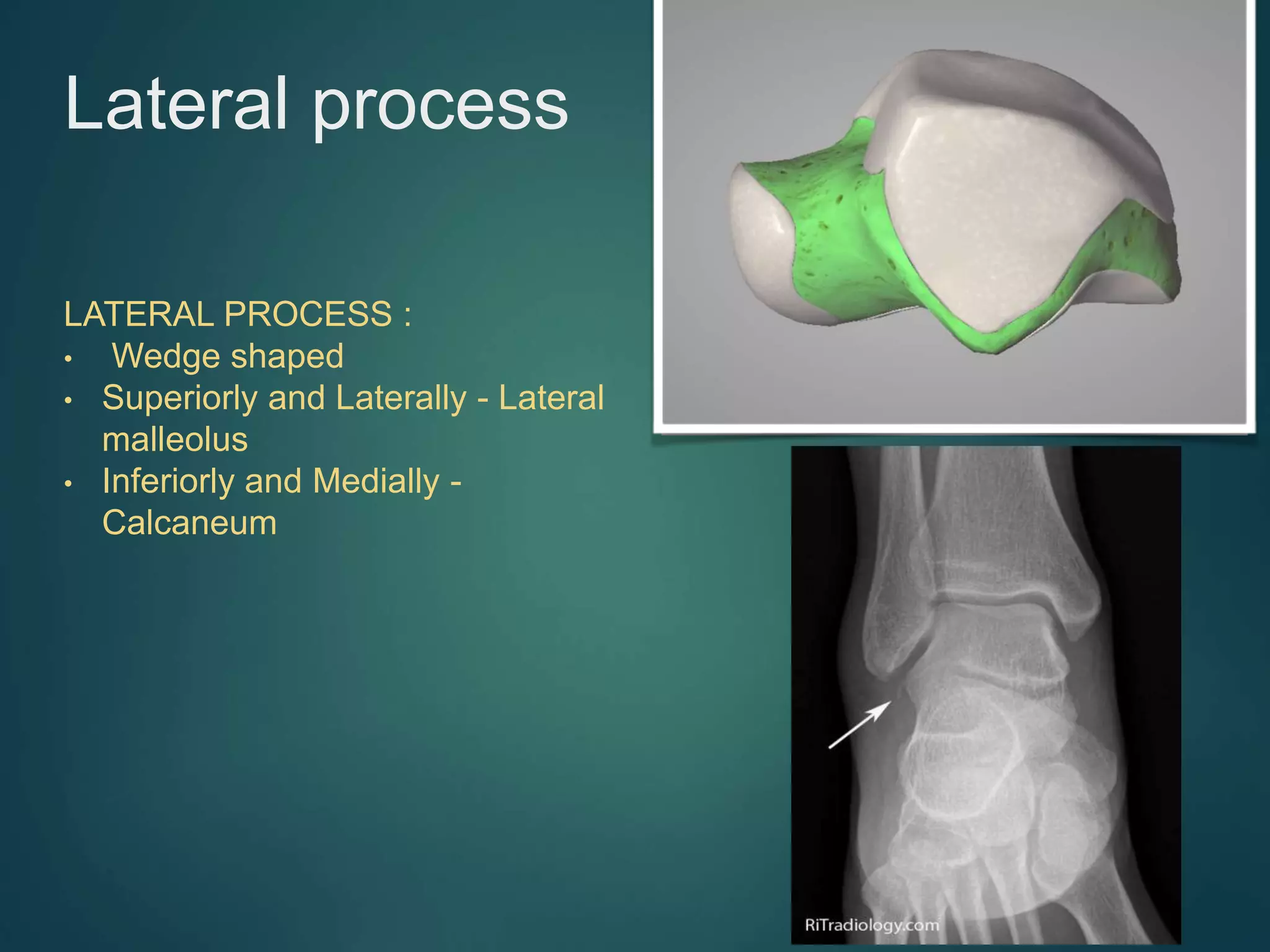 TALUS FRACTURE AND MANAGEMENT. | PPTX