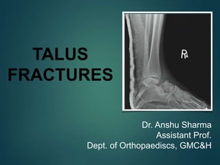 Types Of Talus Fractures