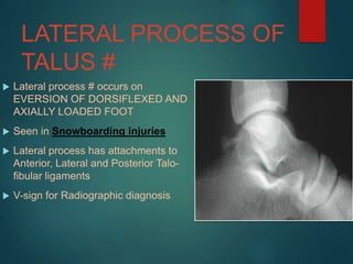 Talus Lateral Process Fracture