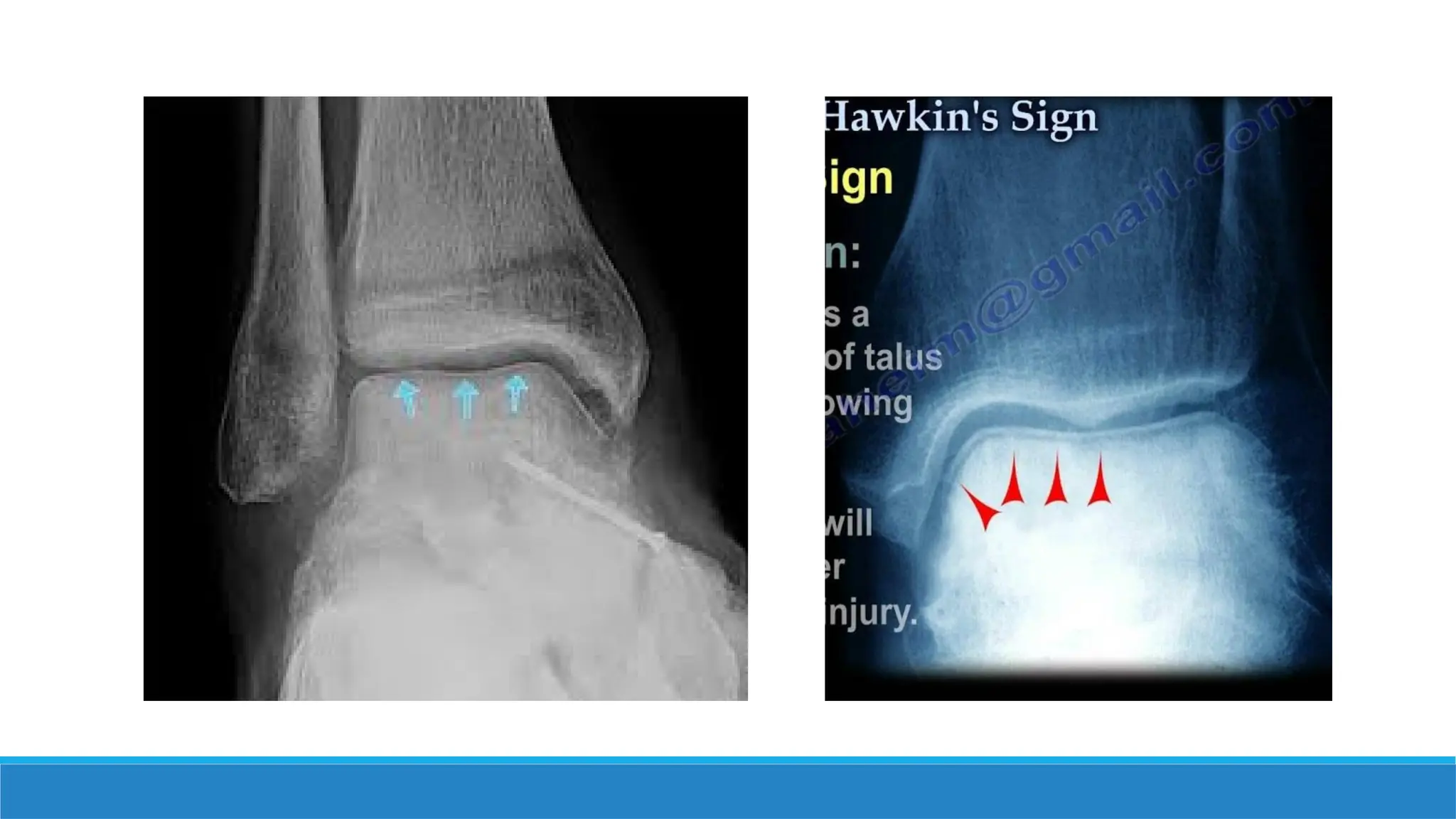 Talar Fractures (Fractures of Talus Bone).pptx