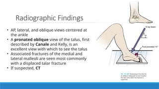 Talar Fractures (Fractures of Talus Bone).pptx