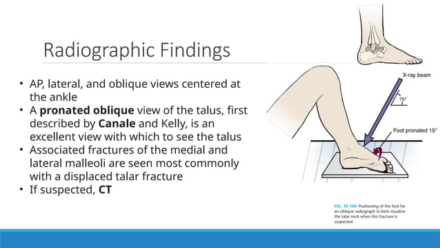 Talar Fractures (Fractures of Talus Bone).pptx