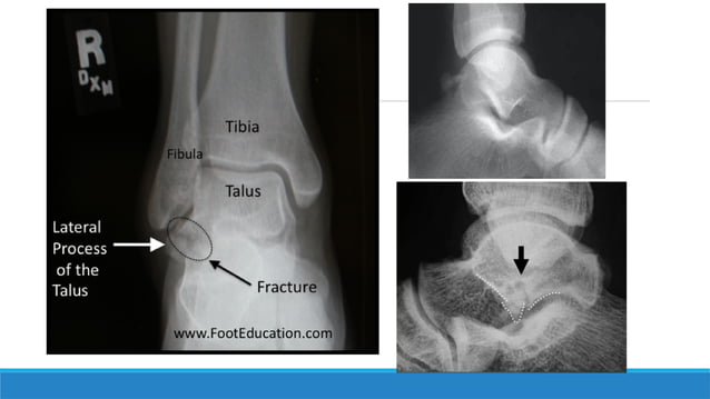 Talar Fractures (Fractures of Talus Bone).pptx