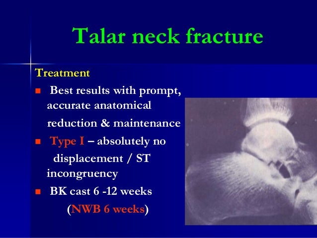 Talar fractures2