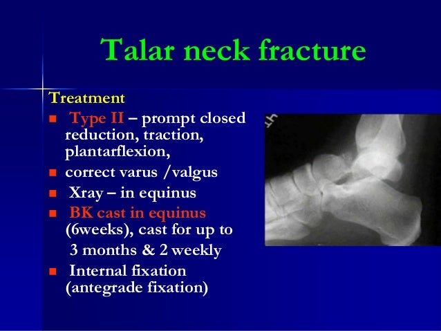 Talar fractures2