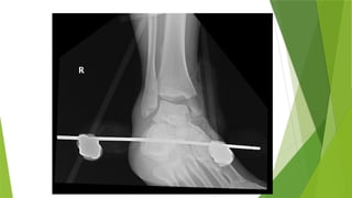 Talar Neck Fracture and dislocation presentation | PPTX