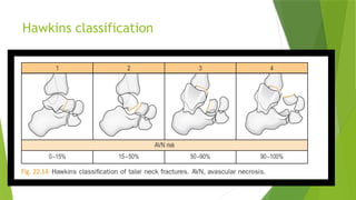 Talar Neck Fracture and dislocation presentation | PPTX