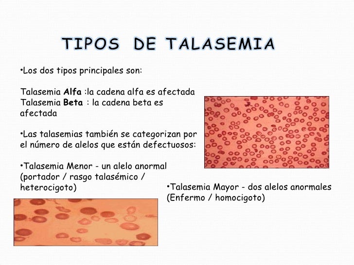 Talasemia