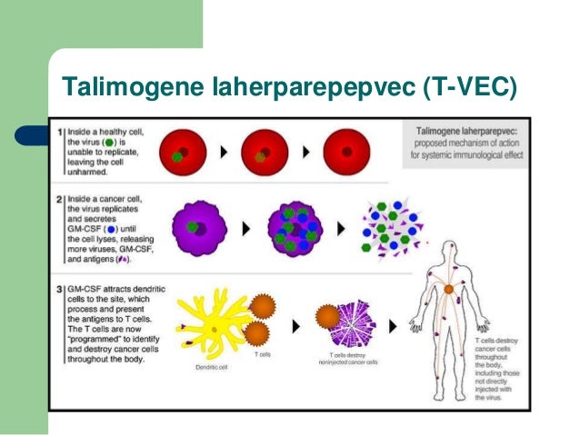 Talimogene (T-VEC) : virotherapy in melanoma