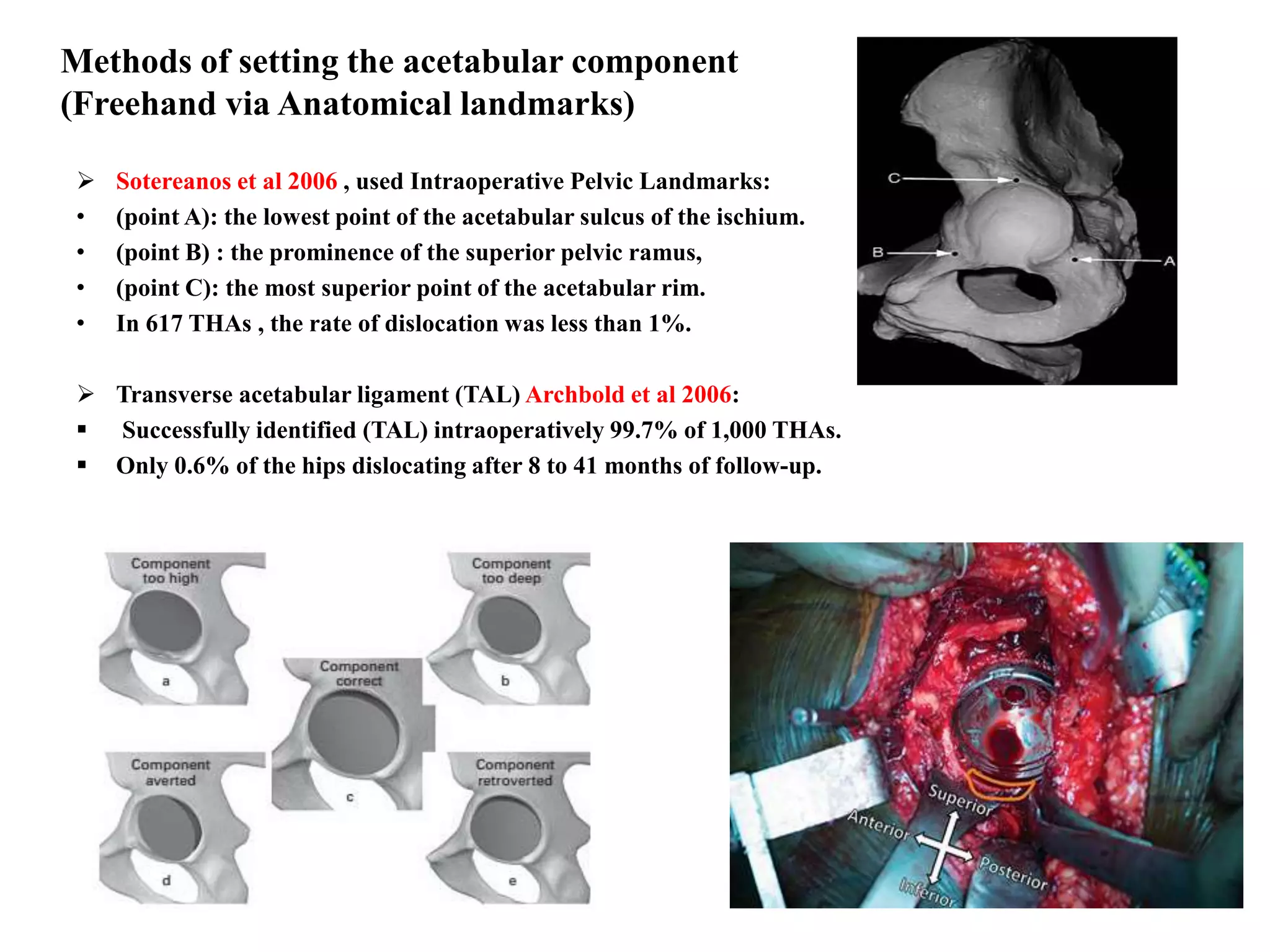 Acetabular component alignment guide in total hip replacement | PPTX
