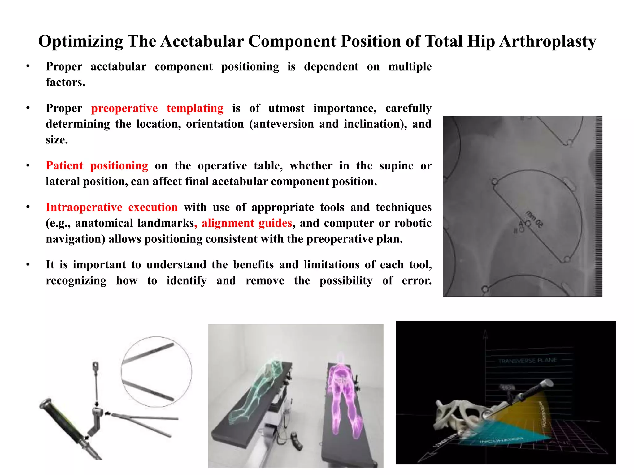 Acetabular component alignment guide in total hip replacement | PPTX