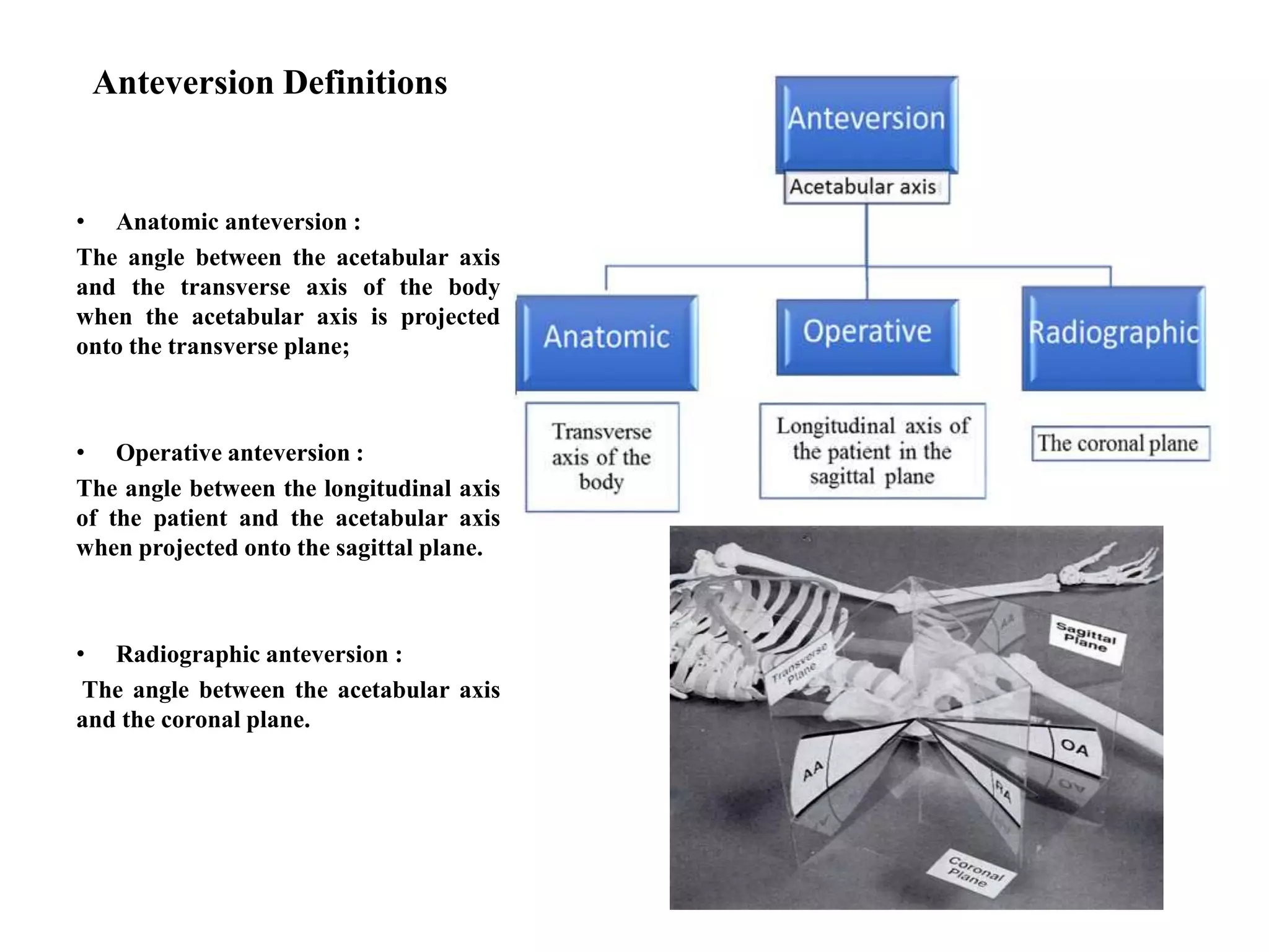 Acetabular component alignment guide in total hip replacement | PPT