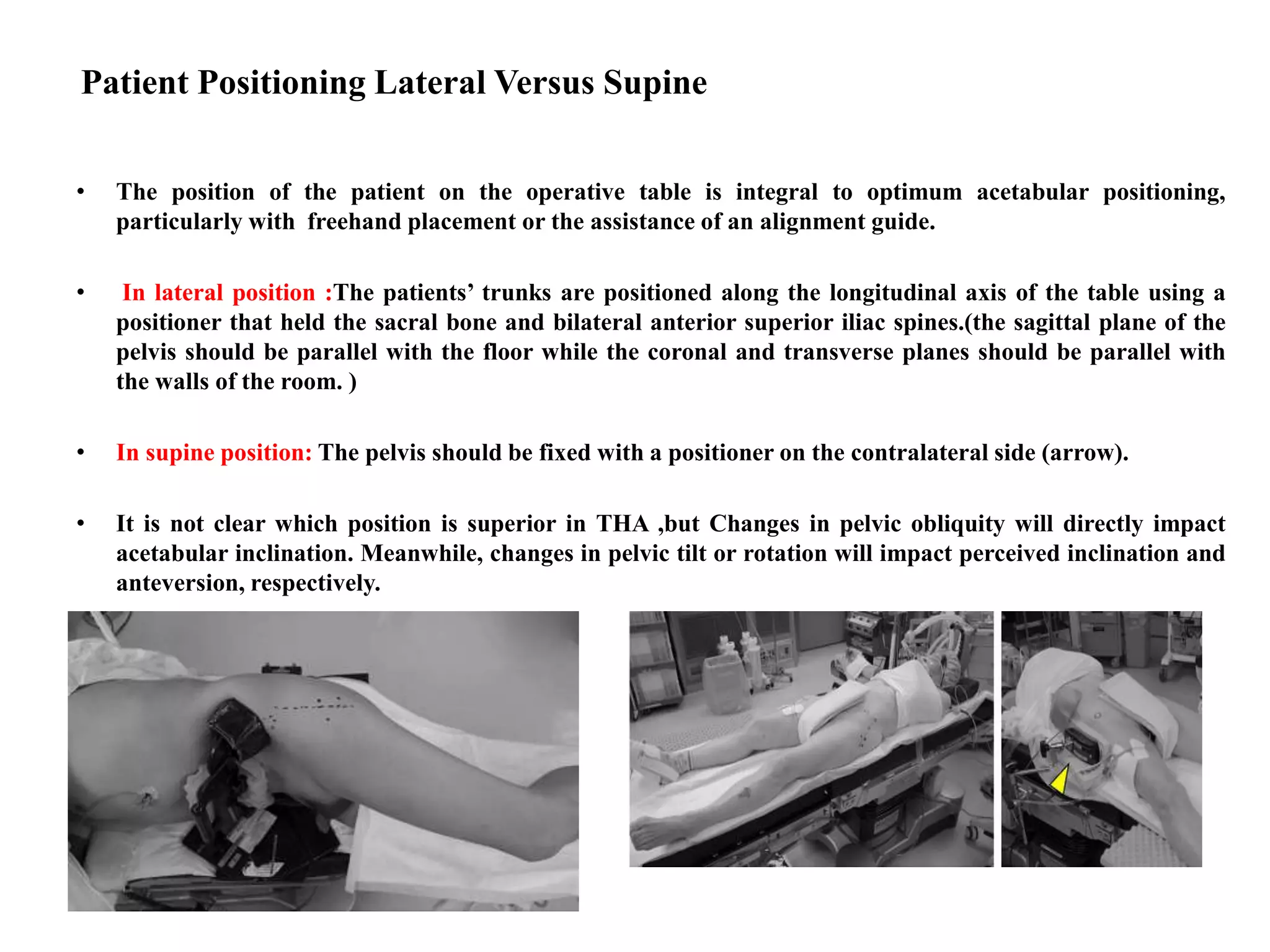 Acetabular component alignment guide in total hip replacement | PPTX