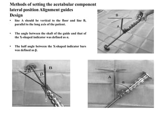 Acetabular component alignment guide in total hip replacement | PPT