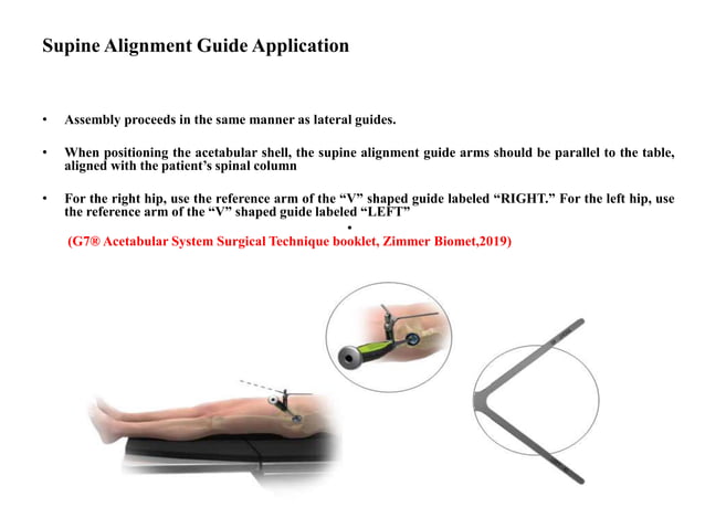 Acetabular component alignment guide in total hip replacement | PPT