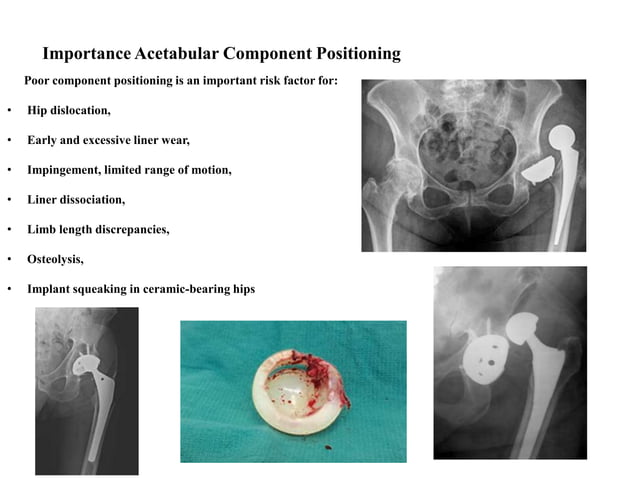 Acetabular component alignment guide in total hip replacement | PPT
