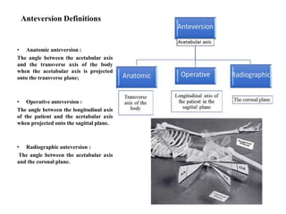 Acetabular component alignment guide in total hip replacement | PPTX