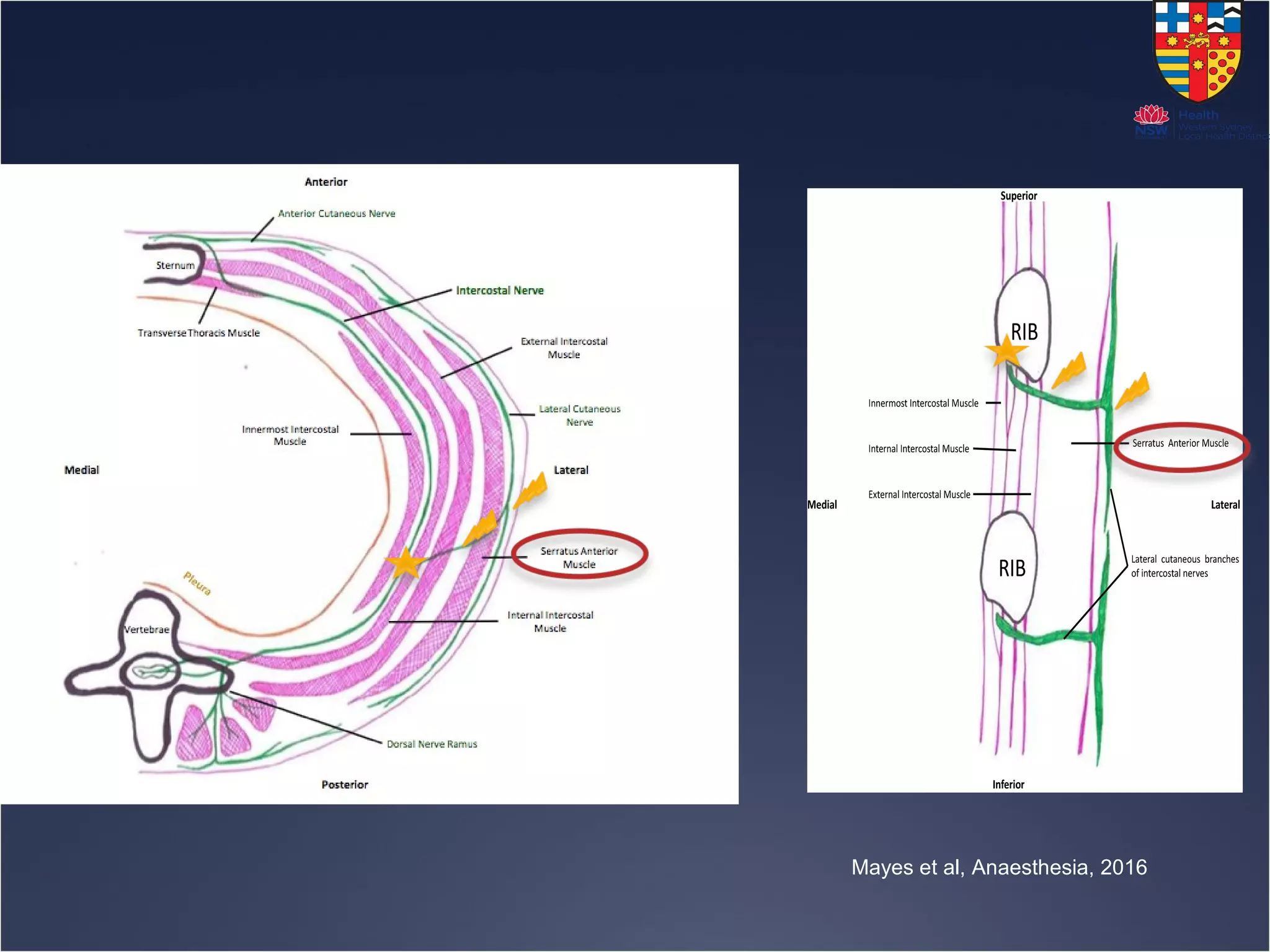 Serratus Anterior Plane Block | PPT