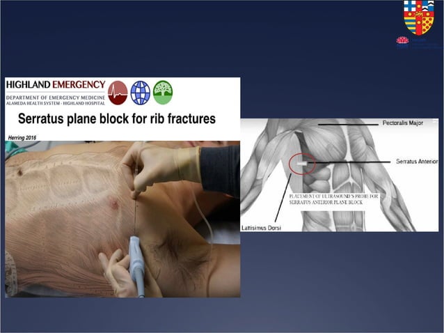 Serratus Anterior Plane Block | PPT