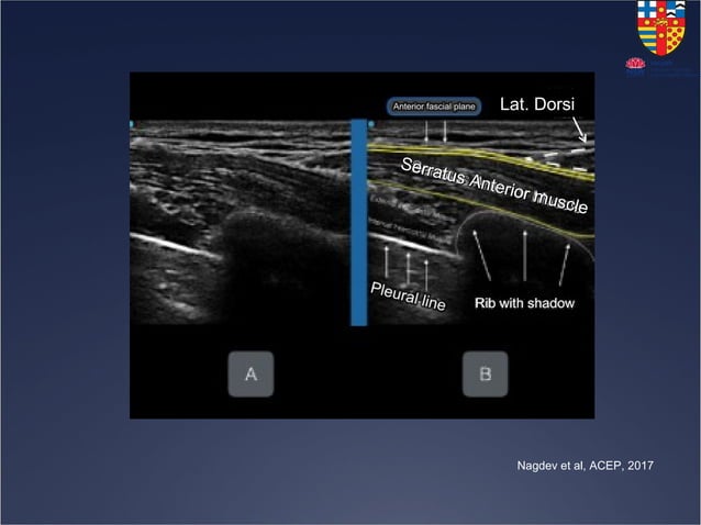 Serratus Anterior Plane Block | PPT
