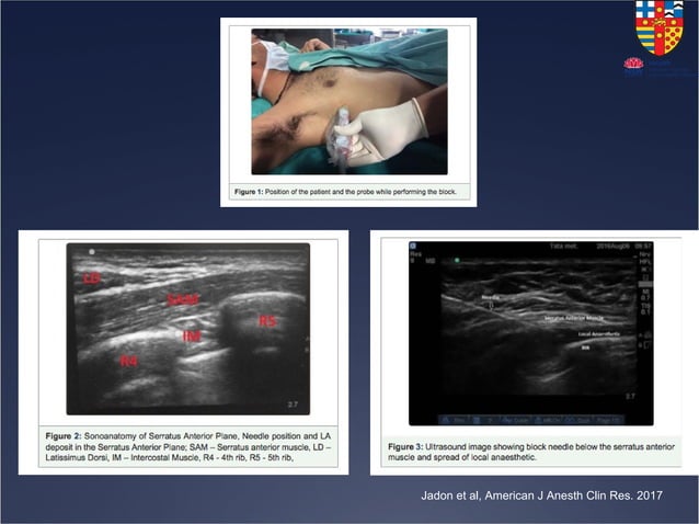Serratus Anterior Plane Block | PPT