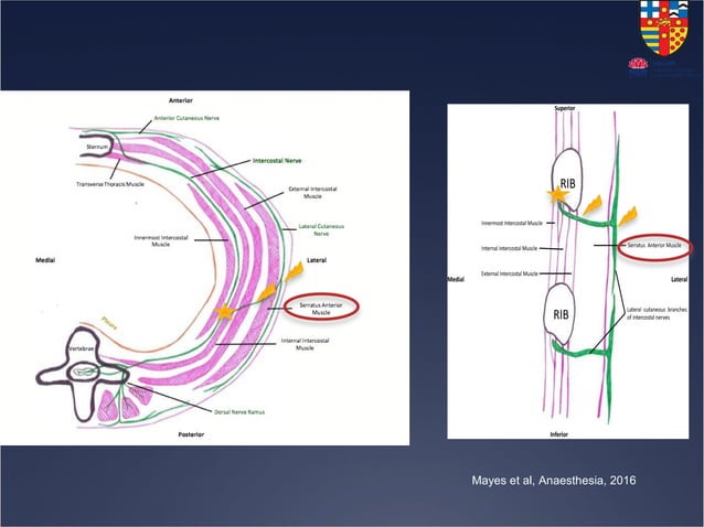 Serratus Anterior Plane Block | PPT