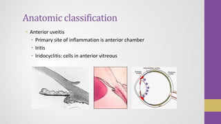 Uvetis, anterior uveitis, posterior uveitis | PDF