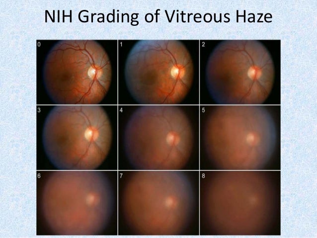 Uvetis, anterior uveitis, posterior uveitis