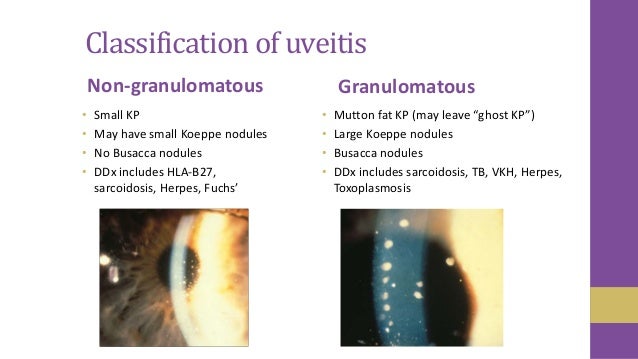 Uvetis, anterior uveitis, posterior uveitis