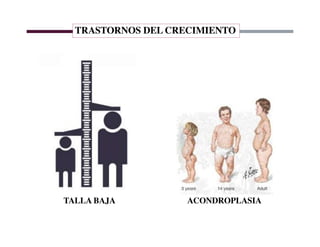 Talla baja y Acondroplasia (resumen pequeño) | PPT