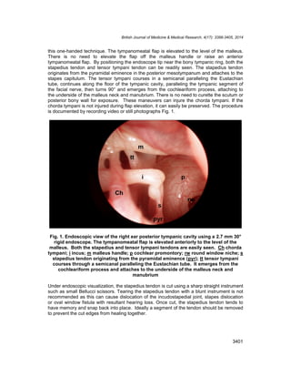 Tractament endoscòpic de la mioclonia de la orella mitja amb el tall ...